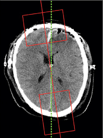 Automated Midline Shift and Intracranial Pressure Estimation based on ...