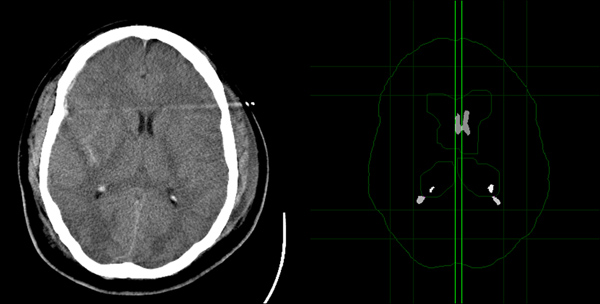 Automated Midline Shift and Intracranial Pressure Estimation based on Brain CT Images | Protocol