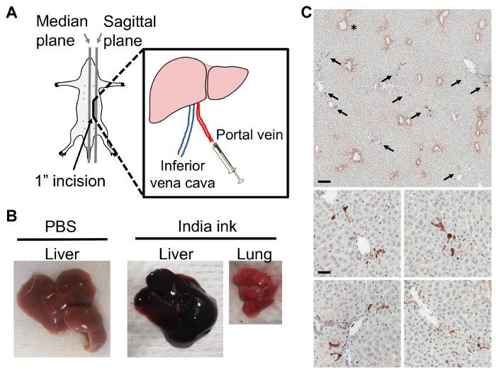 A Portal Vein Injection Model to Study Liver Metastasis of Breast ...