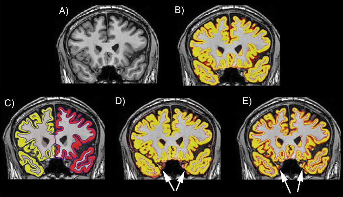 Automated Segmentation of Cortical Grey Matter from T1-Weighted MRI ...